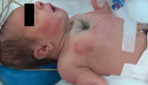 congenital sternal cleft