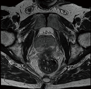 Prostate imaging features that indicate benign or malignant pathology ...