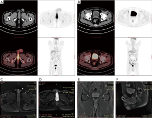 Transperineal-incision urethrectomy combined with laparoscopic ...