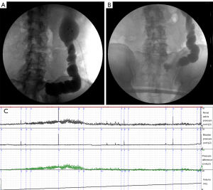 Cine magnetic resonance urography and Whitaker test: dynamic visualized ...