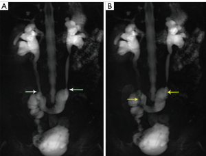Cine magnetic resonance urography and Whitaker test: dynamic visualized ...