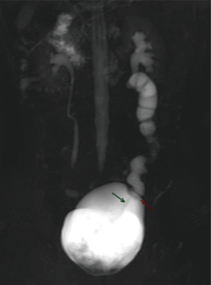 Cine magnetic resonance urography and Whitaker test: dynamic visualized ...