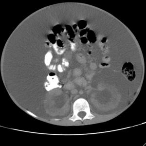 Bilateral renal lymphangiectasia—an unusual cause of abdominal ...