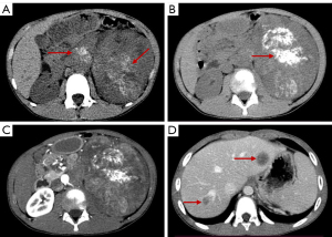 Desmoplastic small round cell tumor: the report of two cases and ...
