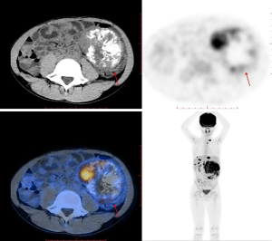 Desmoplastic small round cell tumor: the report of two cases and ...