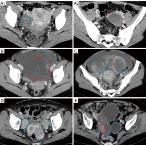 CT-based deep learning segmentation of ovarian cancer and the stability ...