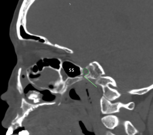 Imaging anatomy of the vidian canal and its clinical significance ...