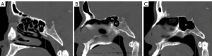 Imaging anatomy of the vidian canal and its clinical significance ...