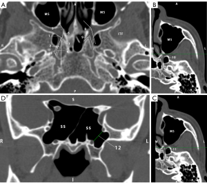 Imaging anatomy of the vidian canal and its clinical significance ...