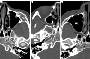 Imaging anatomy of the vidian canal and its clinical significance ...
