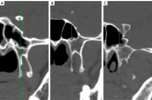 Imaging anatomy of the vidian canal and its clinical significance ...