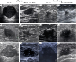 Model based on ultrasound and clinicopathological characteristics for ...