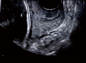 Cervical sliding sign and cervical funneling in the third trimester as ...