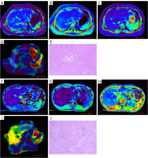 Evaluation of liver fibrosis staging in patients with chronic hepatitis ...