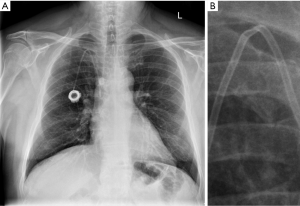 Imaging evaluation of catheter integrity prevent potentially fatal ...