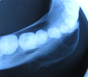 ghost cell calcification