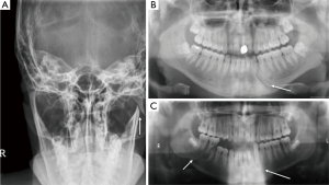 Mandibular Fracture X Ray