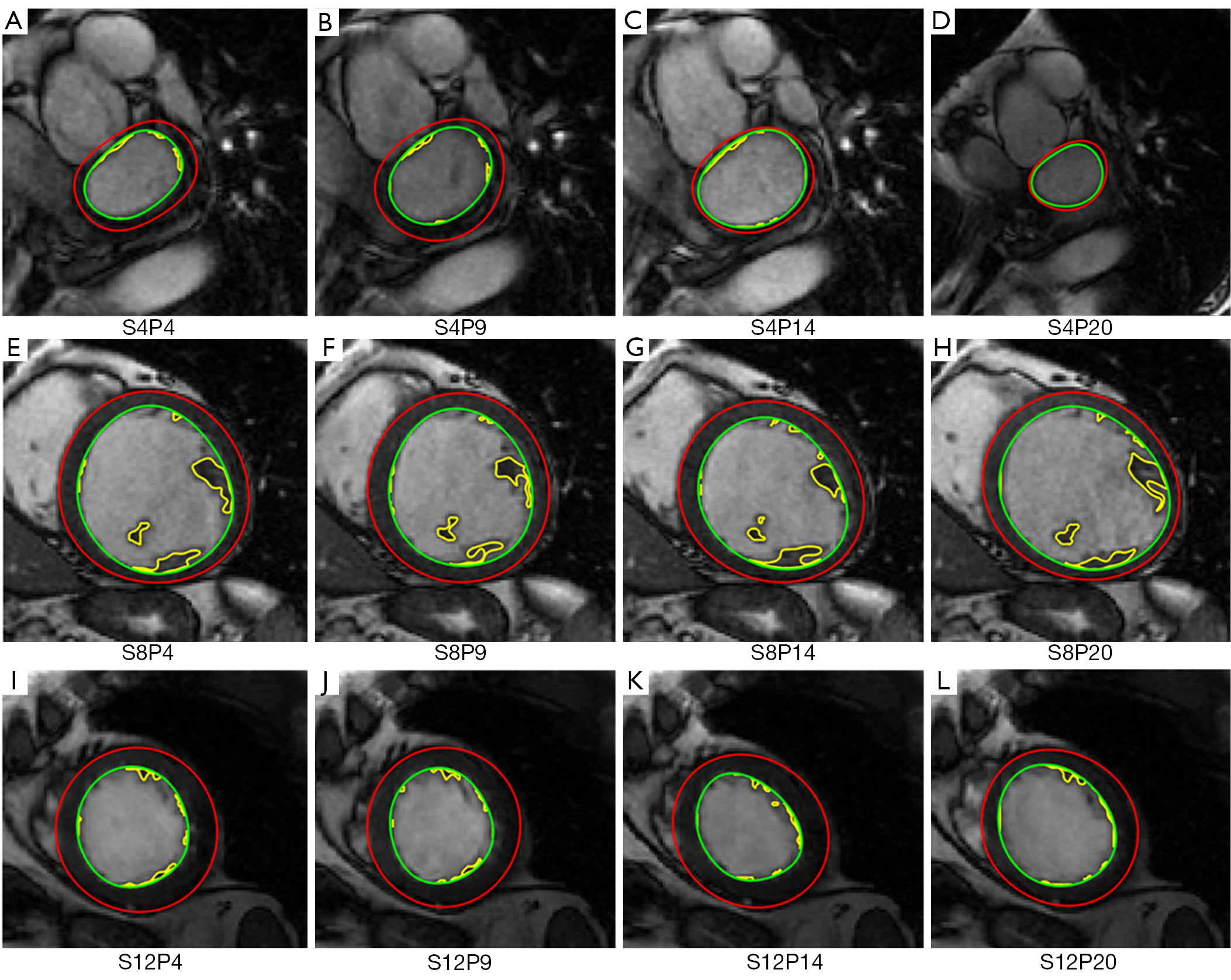 Automatic Segmentation Of Lv And Rv In Cardiac Mri | Ahoy Comics