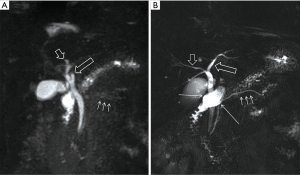 Magnetic resonance cholangiopancreatography at 3T in a single breath-hold: comparative ...