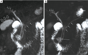 Magnetic resonance cholangiopancreatography at 3T in a single breath-hold: comparative ...