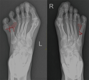 postaxial polydactyly surgery