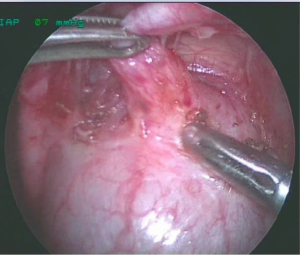 urachal sinus excision