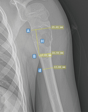 Risk factors for pathological fractures of simple bone cysts of the ...