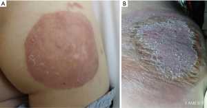lithotripsy bruising