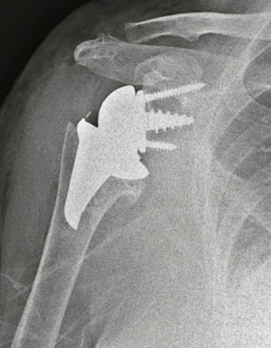 Stemless reverse shoulder arthroplasty: indications, technique and ...
