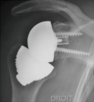 Stemless reverse shoulder arthroplasty: indications, technique and ...