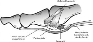 Turf toe: review of the literature and surgical technique - Fraser ...