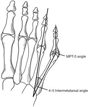The bunionette deformity—evaluation and management - Cooper - Annals of ...