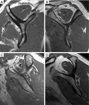 Rotator cuff tears in elderly patients: is repair worthwhile? - Nolte ...