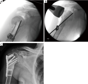 Complications after ORIF of proximal humerus fractures—how to deal with ...