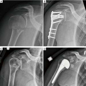 Complications after ORIF of proximal humerus fractures—how to deal with ...