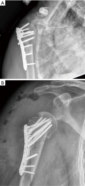 Complications after ORIF of proximal humerus fractures—how to deal with ...