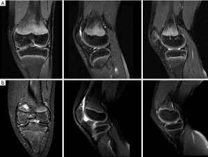 The discoid lateral meniscus in children: a narrative review of ...