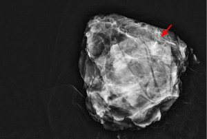 Combined localization technique with radio-guided occult lesion ...