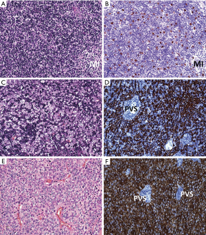 thymus starry sky pattern