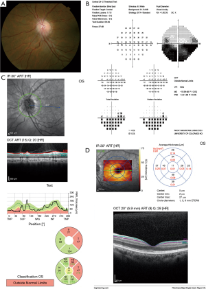 Optical coherence tomography in ischemic optic neuropathy - Fard ...