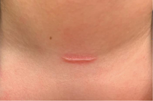 thyroidectomy scar progression