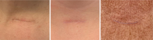 thyroidectomy scar progression