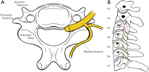 CT guided radiofrequency ablation of the cervical medial branch using a ...