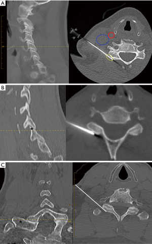 CT guided radiofrequency ablation of the cervical medial branch using a ...
