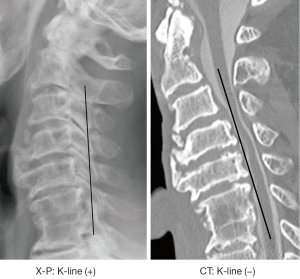 The K-line in the cervical ossification of the posterior longitudinal ...