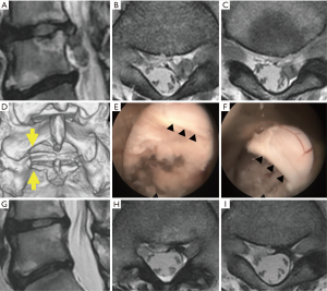 Percutaneous endoscopic lumbar discectomy via adjacent interlaminar ...