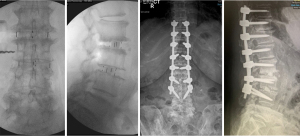 Single position, prone oblique lateral interbody fusion (OLIF)—case ...