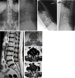 Single position, prone oblique lateral interbody fusion (OLIF)—case ...