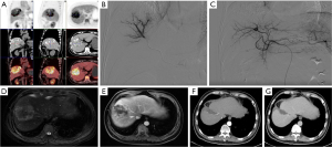 Safety and efficacy of transcatheter chemoembolization combined with ...
