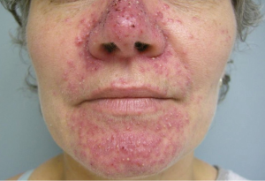 erbitux rash grading